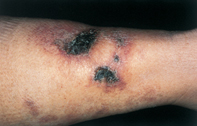Skin necrosis with vascular calcification | Medicine Today