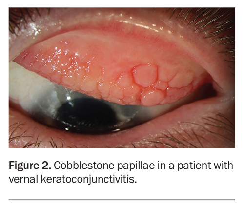 Allergic conjunctivitis: subtypes and management strategies | Medicine ...