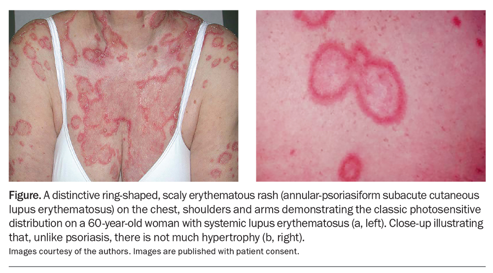 Systemic lupus erythematosus: unmasking the masquerader | Medicine Today